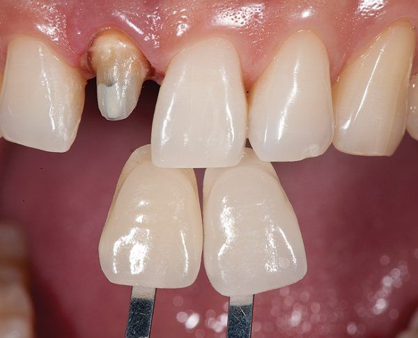 La importancia de la toma de color en la práctica dental